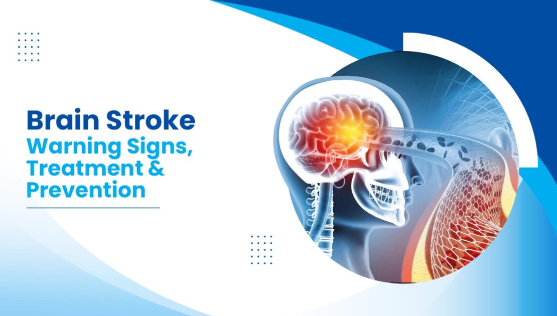 Warning Signs of Brain Stroke